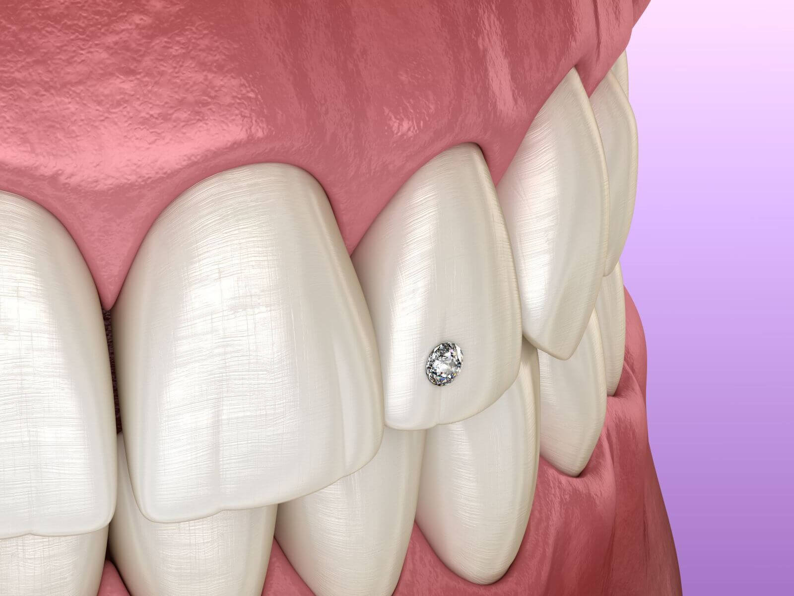 Zahnästhetik in Leipzig - Schöne Zähne dank Smile Health